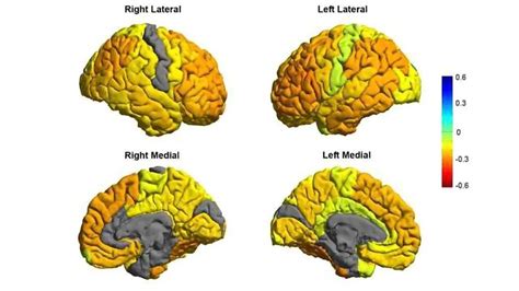 Understanding The Neurobiological Basis Of Bipolar Disorder Subtypes