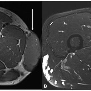 Axial T1 Weighted And T2 Weighted Fat Saturated Magnetic