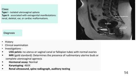 Congenital Anomalies Of Female Genital Tract Pptx