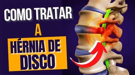H Rnia De Disco Lombar Melhores Exerc Cios Para Aliviar Dores E