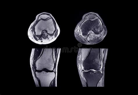 Mri Knee Joint Or Magnetic Resonance Imaging Stock Image Image Of Femur Bone 161522013