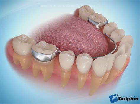 North Shore Orthodontics Lower Lingual Holding Arch
