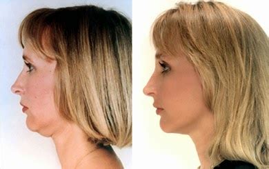 Liposuccion Double Menton Meteor