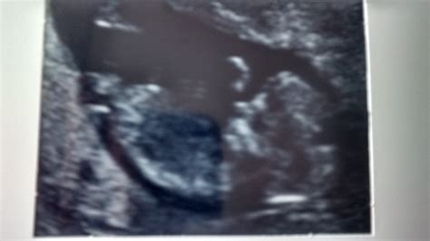 12 Week Scan Gender Guess Mumsnet