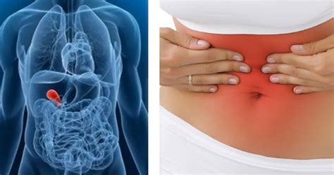 Cómo prevenir la inflamación de la vesícula naturalmente