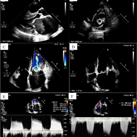 Echocardiogram Showing Two Mitral Valve Vegetations A Anterior Leaflet