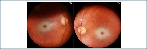 Tay Sachs Disease A Case Report Revista Brasileira De Oftalmologia