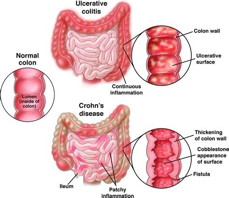 Crohns Archives AGA GI Patient Center