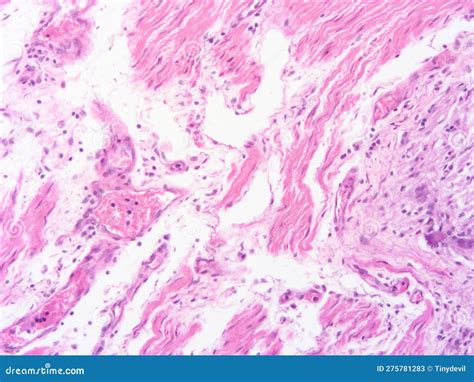 Histology Of Human Tissue Show Necrosis Of Skeletal Muscle As Seen