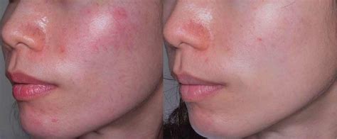 Laserowe usuwanie naczynek Zielona Góra usuwanie rumienia Derma Clinic