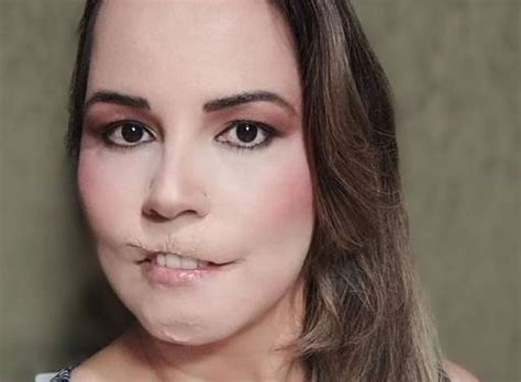 Mulher perde o lábio superior após fazer preenchimento PMMA