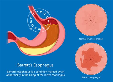 Understanding Barrett S Esophagus Gastrointestinal Diseases Inc