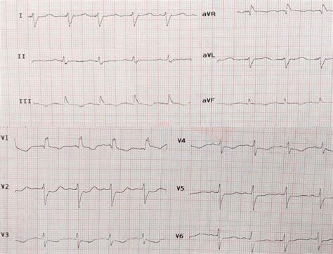 Electrocardiogram Showing Sinus Rhythm With Right Bundle Branch Block