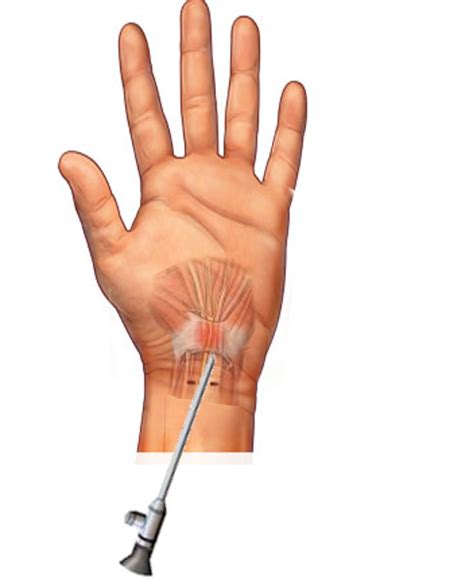 Figure Carpal Tunnel Syndrome Image Courtesy S Bhimji MD