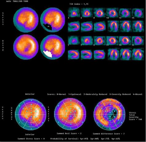MON CARDIOLOGUE Scintigraphie