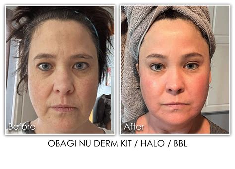 12 BBL HALO NUDERM KIT Skin Rejuvenation Clinic Skin Rejuvenation Clinic