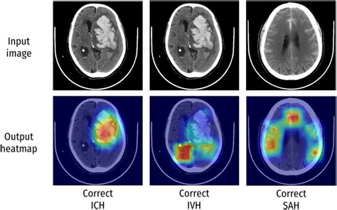 automated identification of chest radiographs with referable abnormality with deep learning