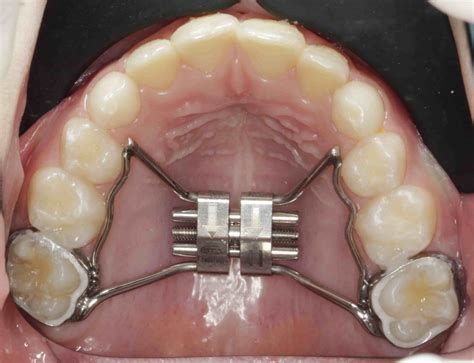 ORTODONCIA INFANTIL TIPOS DE TRATAMIENTOS Clínica Dental en Sevilla