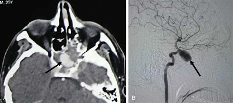 Emergencies In Head And Neck Radiology Key