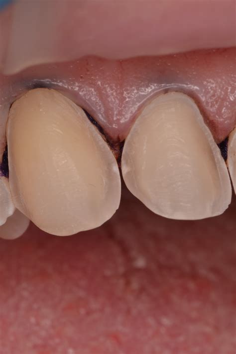 Removable Prosthodontics Implants Same Day Model Free Crowns Full