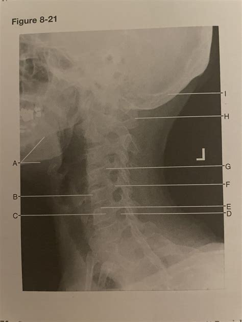 Cervical Vertebrae Pa Ap Axial Oblique Projection Diagram Quizlet