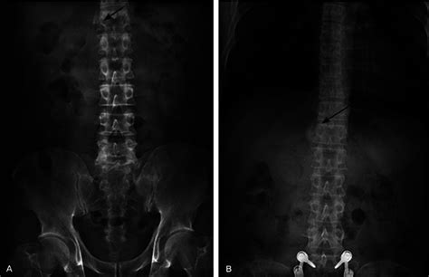 A Four Years Ago Anteroposterior Radiography Of Lumbar Spine Of 47