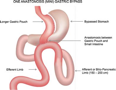 Pictorial Representation Of One Anastomosis Mini Gastric Bypass