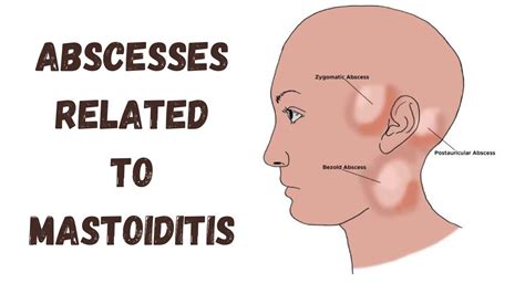 Abscesses Related To Mastoiditis Complications Of Otitis Media YouTube