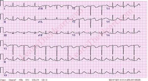 Long QT Syndrome Diagnosis And Treatment Mayo Clinic 43 OFF