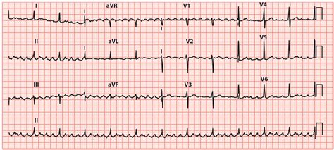 Atrial Flutter Litfl Ecg Library Diagnosis
