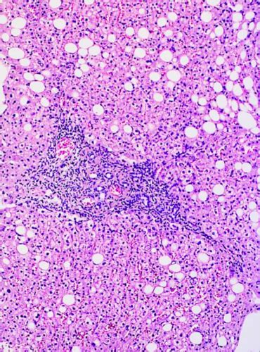 Liver Pathology Ii Specific Diseases Flashcards Quizlet