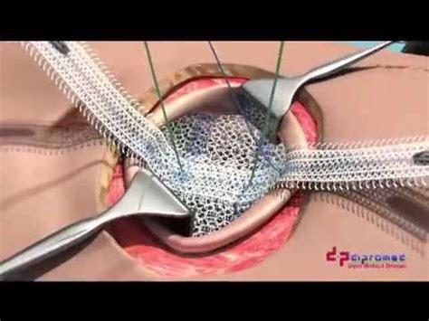 Ucmc Clearmesh Composite Umbilical Hernia Repair Artofit