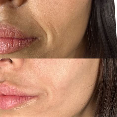 Smile Lines Nasolabial Fold Fillers Designer Aesthetics By Dr