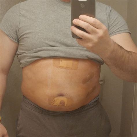 TJ Allison Gallbladder Surgery Gallbladder Gallbladder Surgery