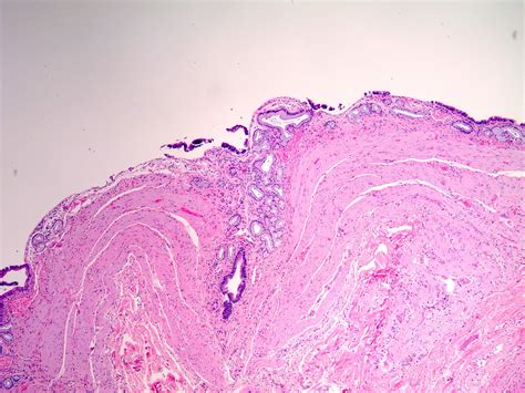 Cholecystitis Histology