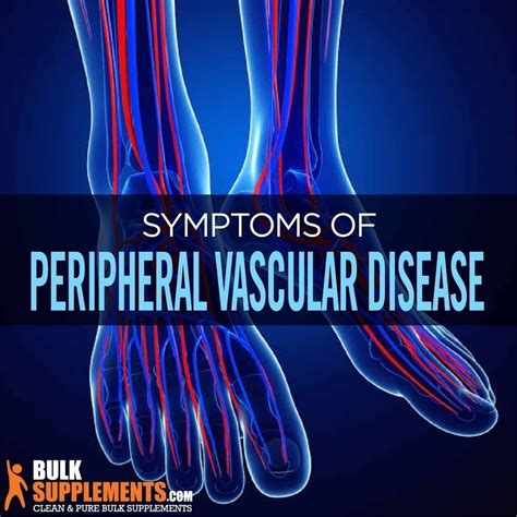 Tablo Read Peripheral Vascular Disease Symptoms Causes Treatment By