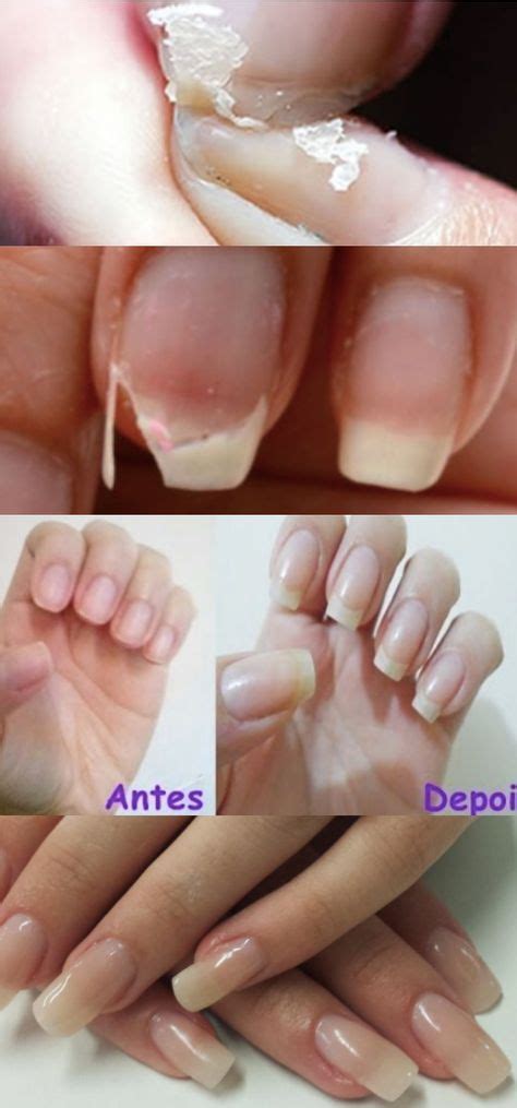 Combata As UNHAS FRACAS Sem Sair De CASA Estas 2 Receitas Caseiras