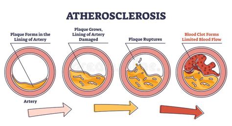 Explication Des Stades De L athérosclérose Et Formation De Plaques