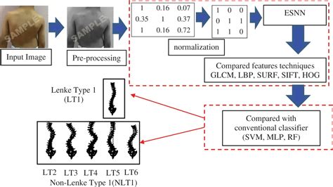 integrated evolving spiking neural network and feature extraction methods for scoliosis