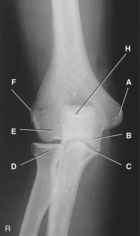 AP Oblique Lateral Rotation Elbow Diagram Quizlet