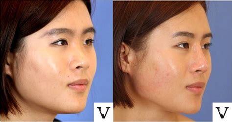 Non Surgical Rhinoplasty Nose Job For Dorsum Agumentation Enhancing