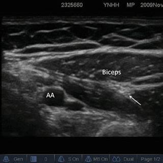 Axillary Nerve Ultrasound
