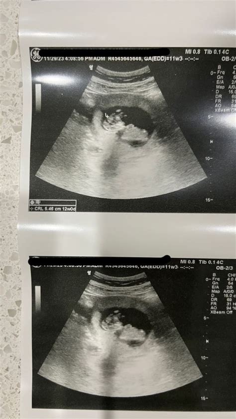 Ultrasound Gender Guess June Babies Forums What To Expect