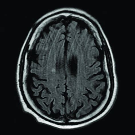 MRI Of The Brain With And Without Contrast Axial T2 FLAIR View Showing