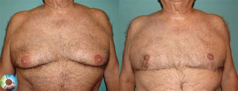 Boob Reduction Surgery Telegraph