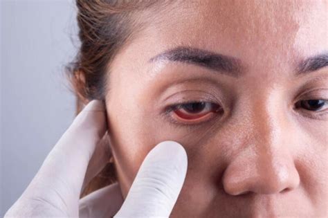 5 Penyebab Mata Merah Sebelah Dan Gejalanya Yang Harus Diketahui