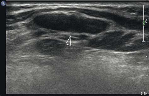 7 Pleura And Thorax Radiology Key