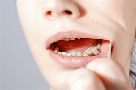 Gum Grafting A Dental Service By Bedrock Laser Periodontics Implants