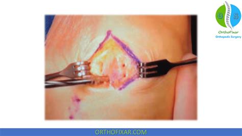 MPFL Reconstruction Surgery OrthoFixar 2024