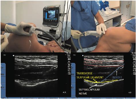 Position Of The Patient And Ultrasound Transducer For The Realization